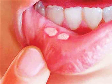 Tention Also Reason For Mouth Ulcers - Gorakhpur News