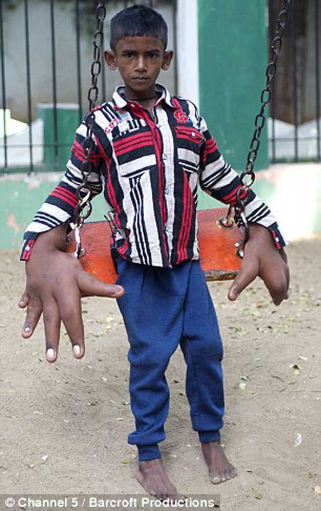 Hope For The Boy With The Worlds Biggest Hands Indian Boy Born With A ...
